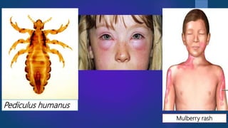 Typhus , yellow , dengue ..also deals with causative agents insects ...