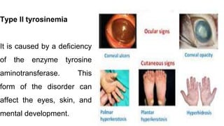 Tyrosinosis | PPT