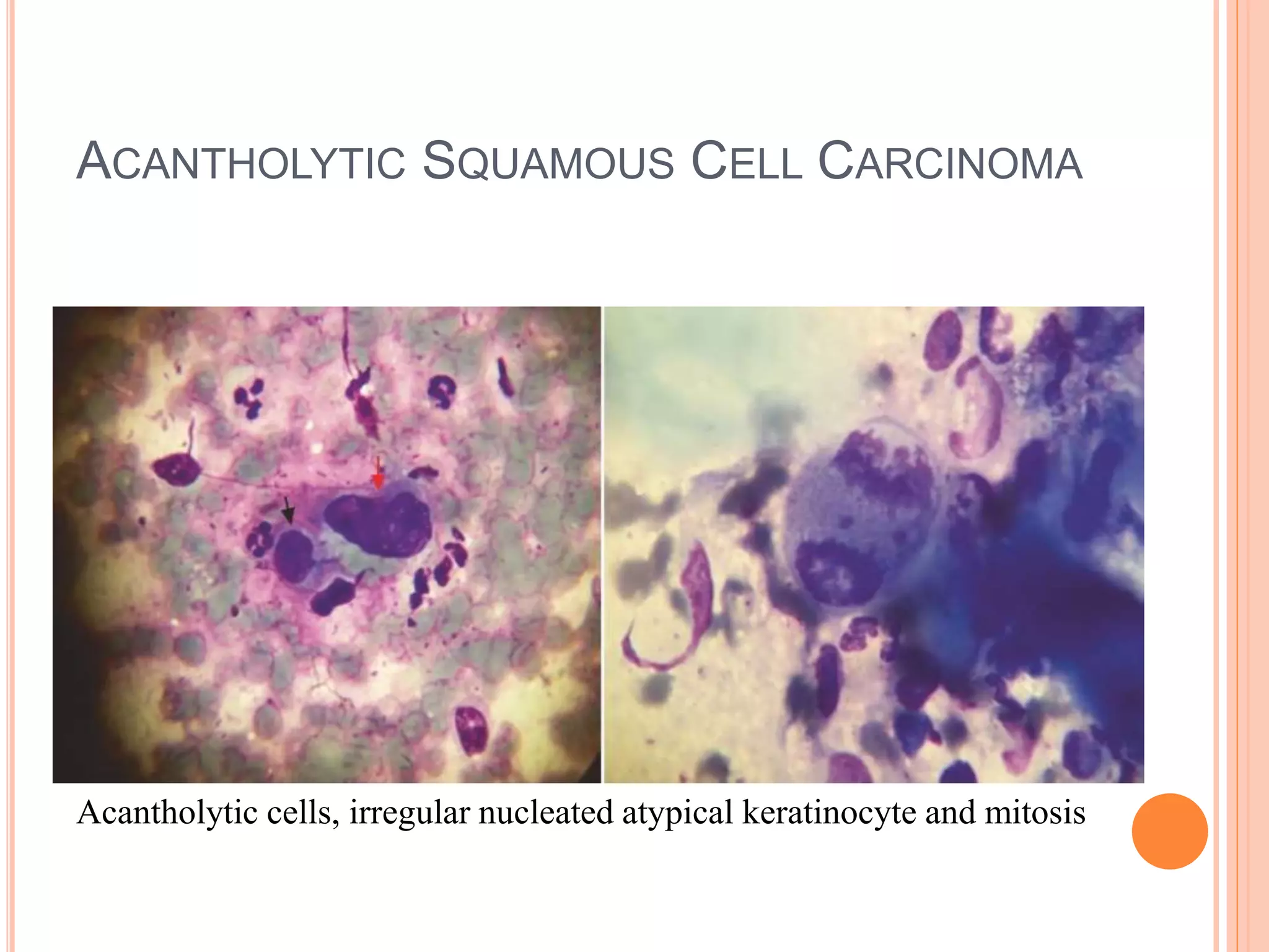 Tzanck Smear | PPTX