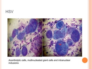 Tzanck Smear Multinucleated Giant Cells