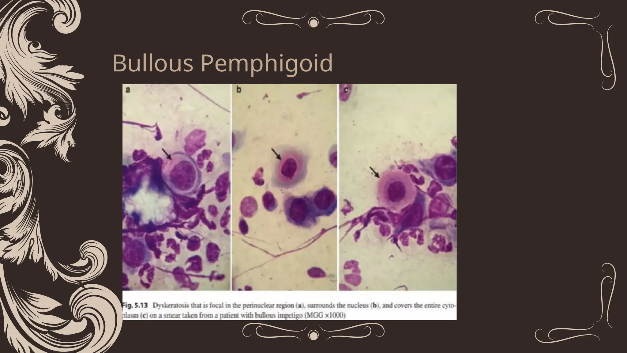 tzanck smear in psoriasis - investigation | PPTX