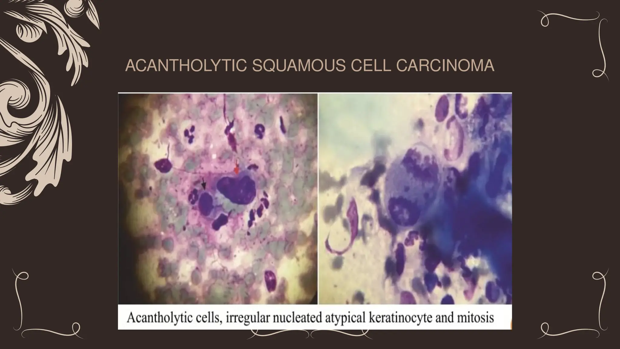 tzanck smear in psoriasis - investigation | PPTX