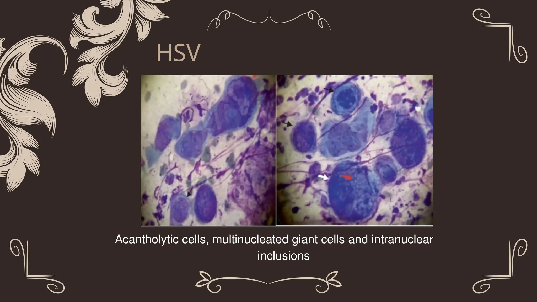 tzanck smear in psoriasis - investigation | PPTX
