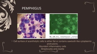 tzanck smear in psoriasis - investigation | PPT