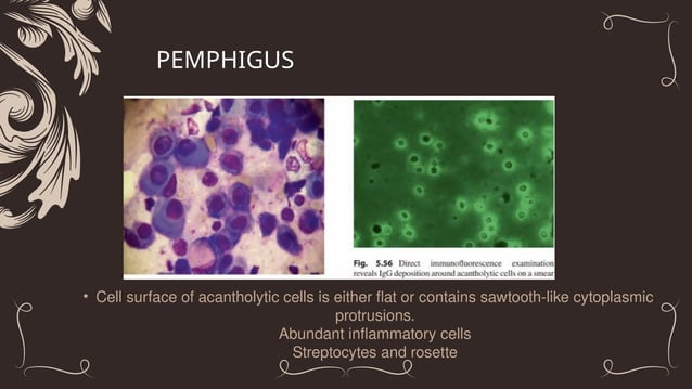 tzanck smear in psoriasis - investigation | PPT