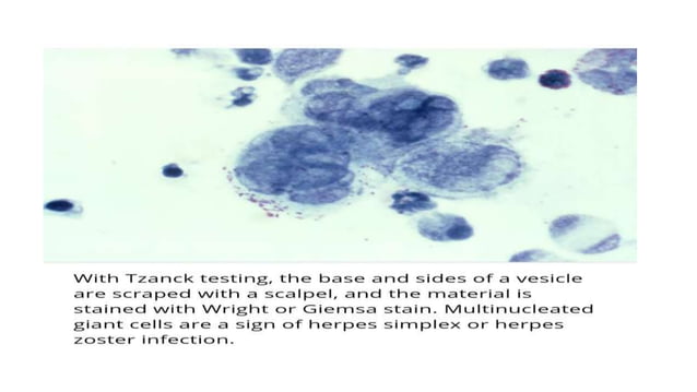 tzanck smear.pptx | Skin and Dermatology | Diseases and Conditions