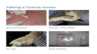 tzanck smear.pptx