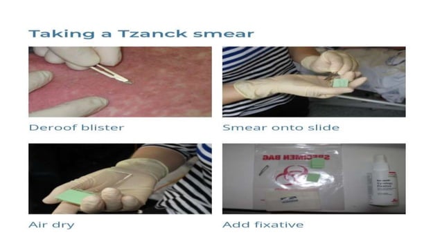 tzanck smear.pptx | Skin and Dermatology | Diseases and Conditions