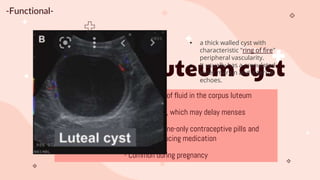 U-nang-buồng-trứng (1).pptx