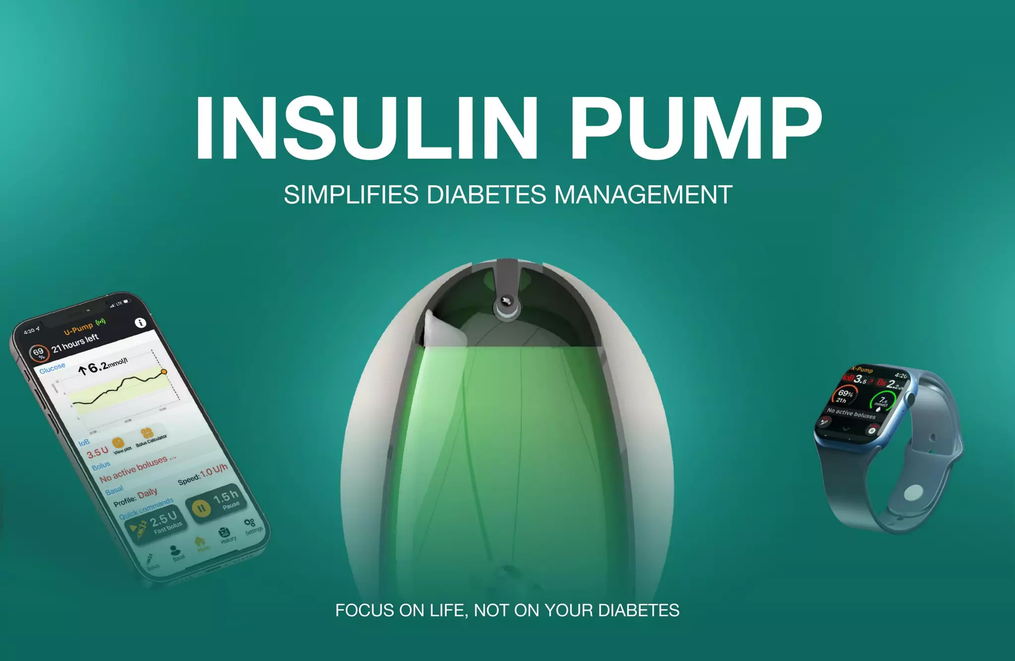 U-PUMP New Insulin Pump | PDF