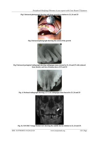 Peripheral Ossifying Fibroma Radiograph