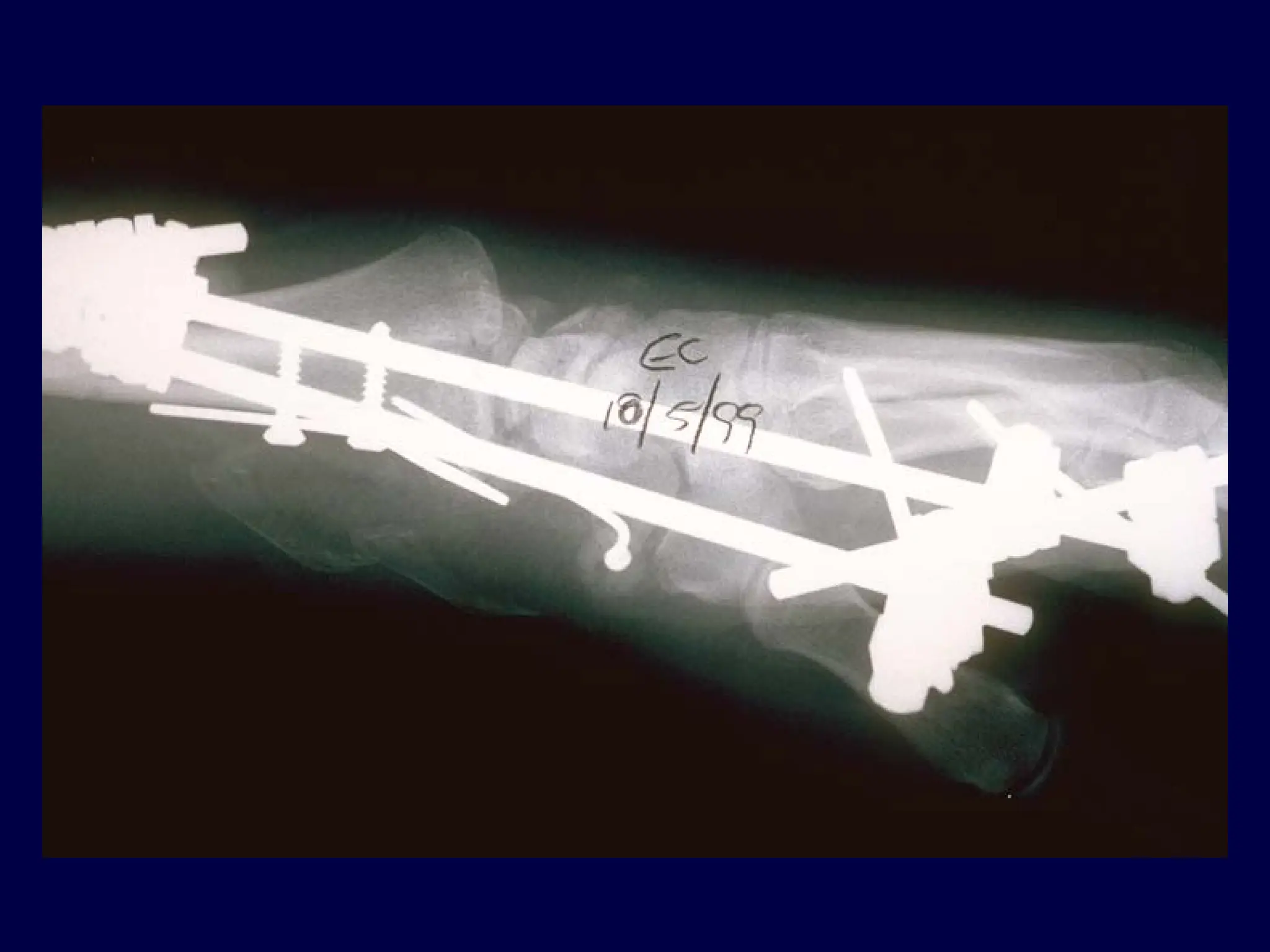 Distal Radius Fractures(DER) colless.pdf