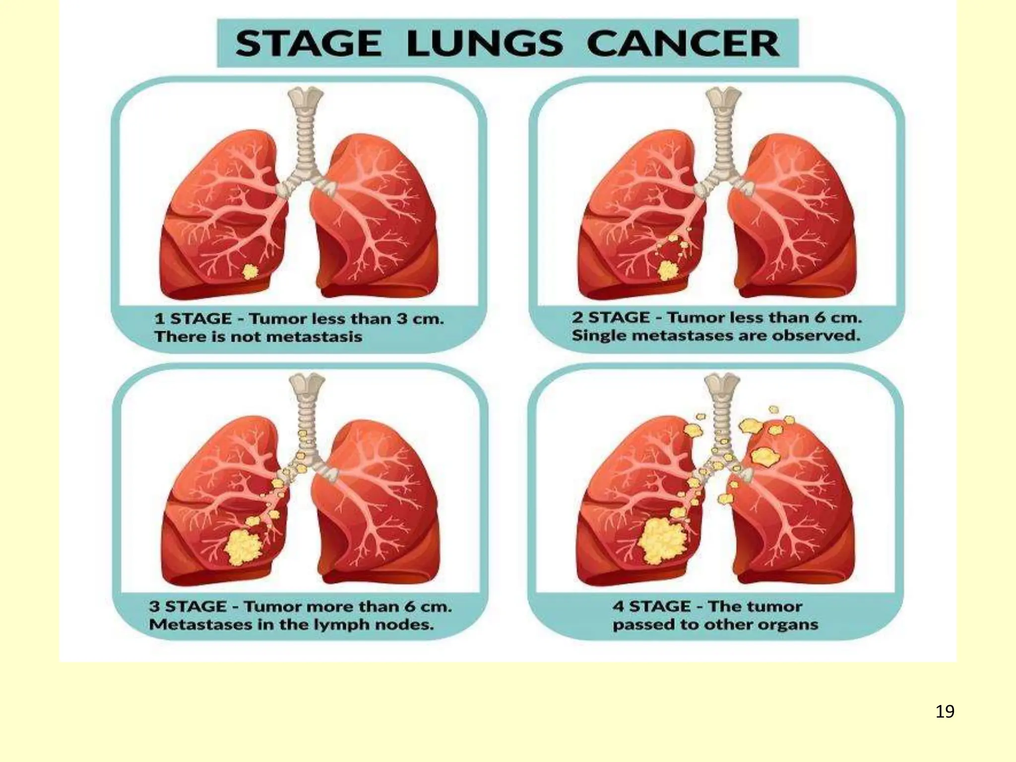 Lung cancer - definition, causes, symptoms, diagnosis, treatment ...