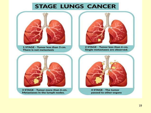 Lung cancer - definition, causes, symptoms, diagnosis, treatment ...
