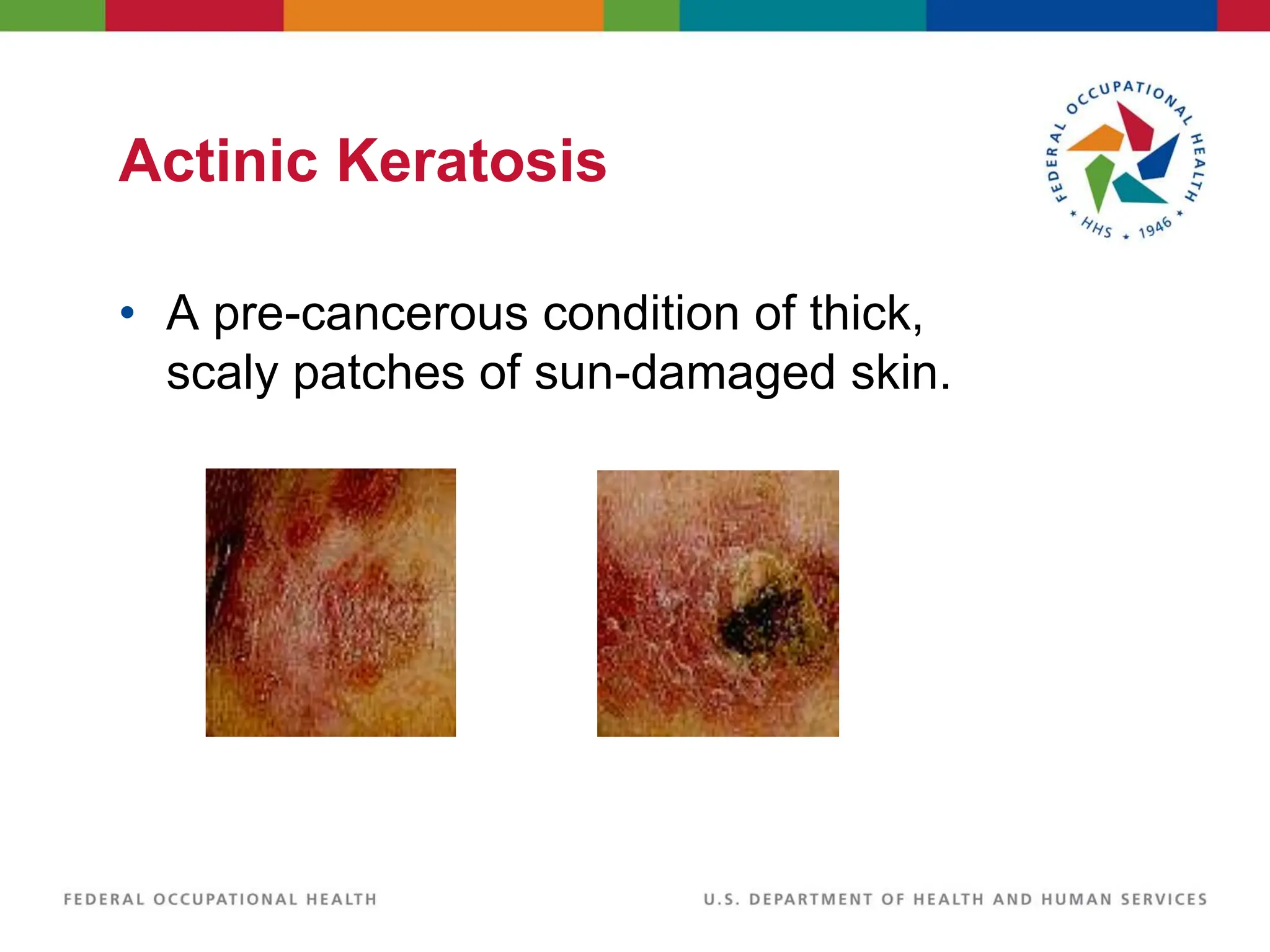 Oral cancer - definition, causes, risks, symptoms, diagnosis and ...