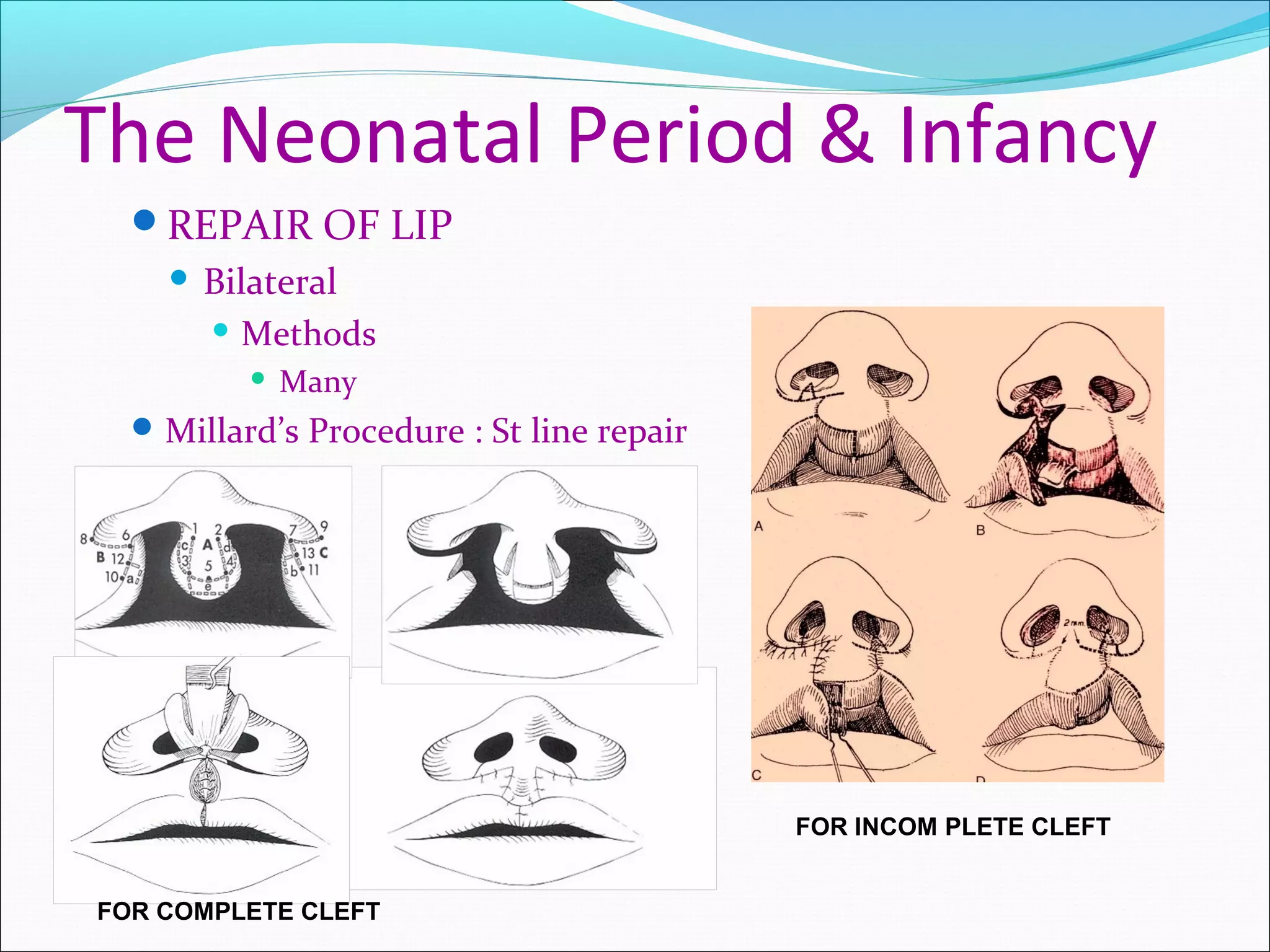 Clinical aspects of cleft lip and palate reconstruction 2 rec | PPT