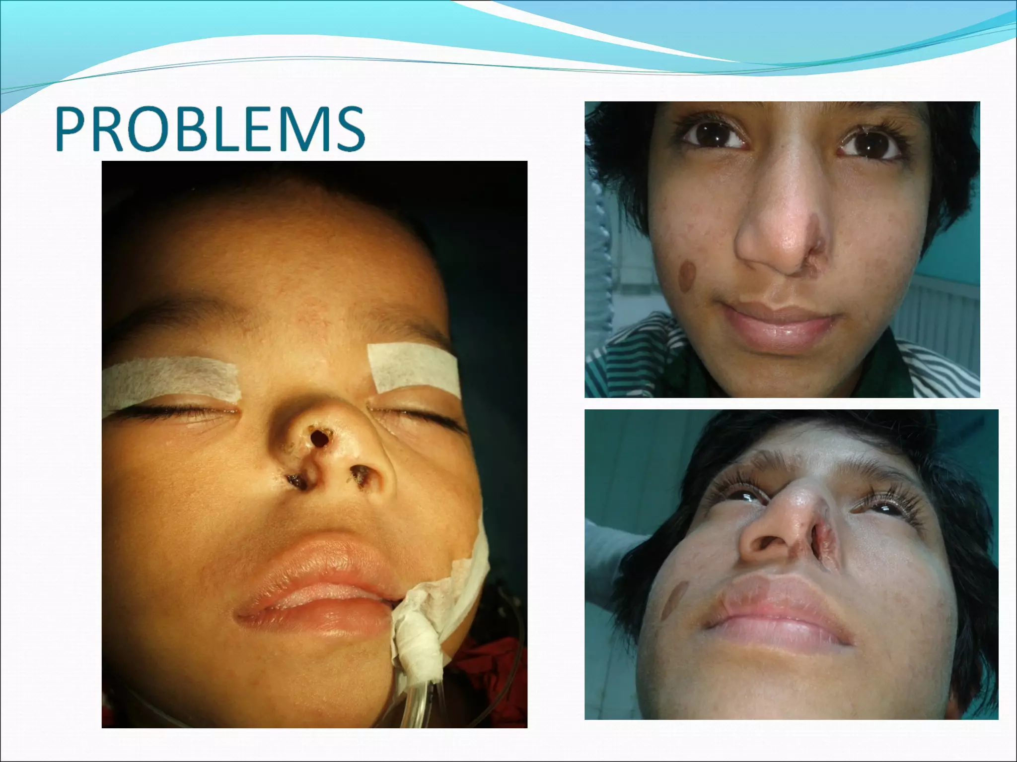 Clinical aspects of cleft lip and palate reconstruction 2 rec | PPT