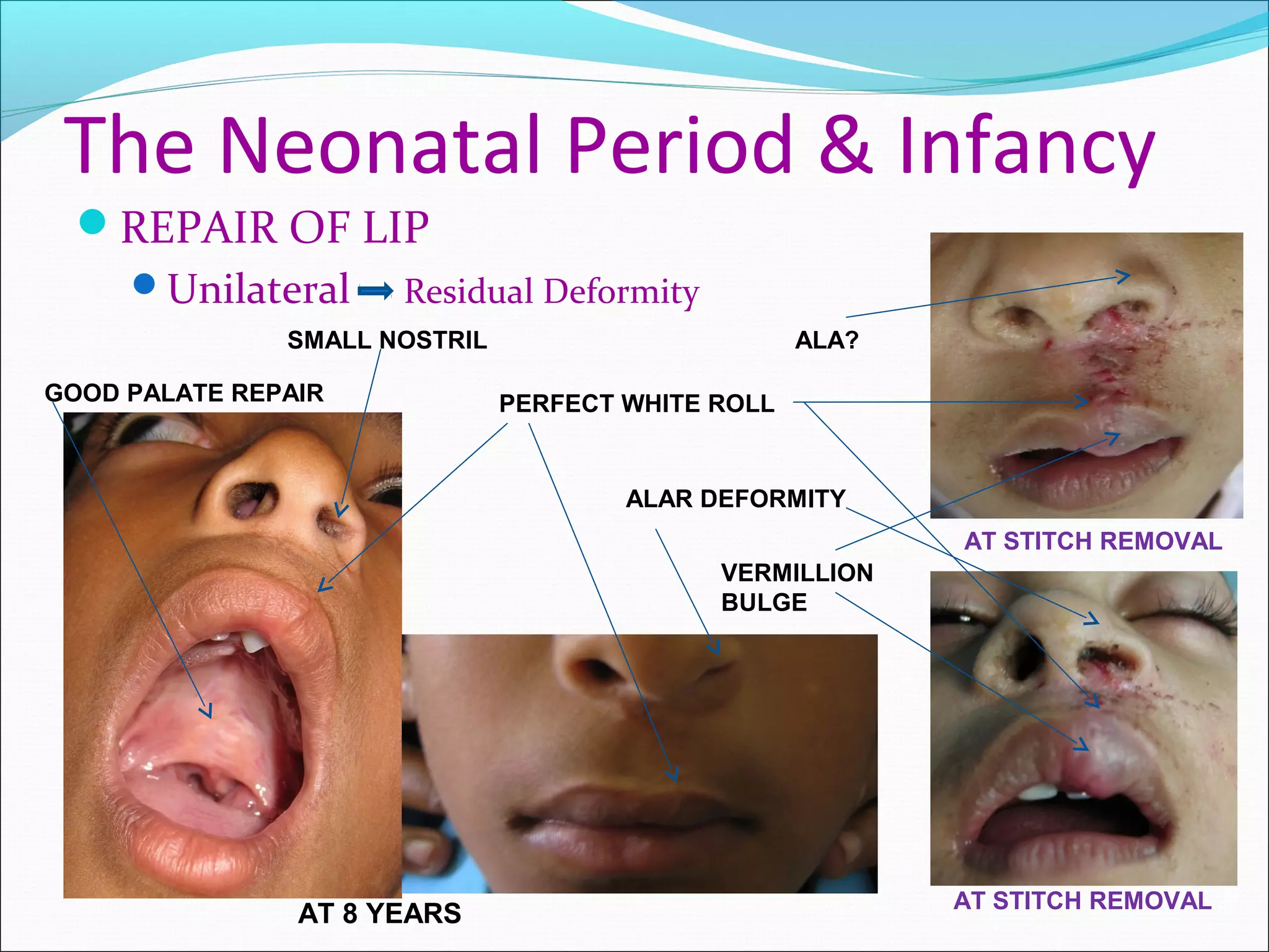 Clinical aspects of cleft lip and palate reconstruction 2 rec | PPT