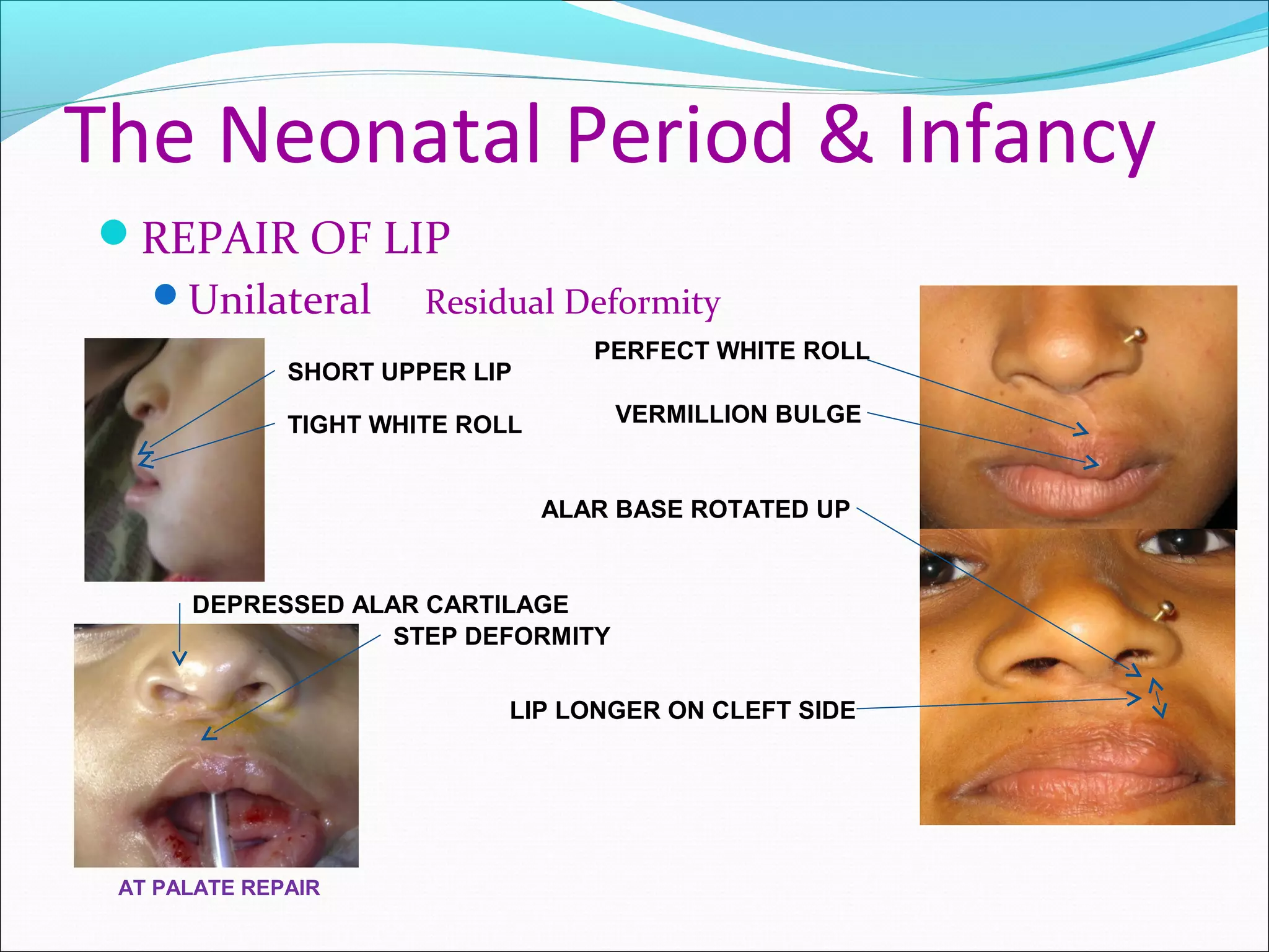 Clinical aspects of cleft lip and palate reconstruction 2 rec | PPT