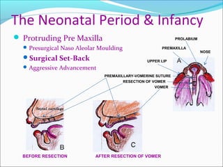 Clinical aspects of cleft lip and palate reconstruction 2 rec | PPT ...