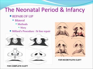 Clinical aspects of cleft lip and palate reconstruction 2 rec | PPT