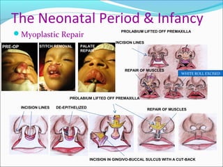 Clinical aspects of cleft lip and palate reconstruction 2 rec | PPT ...
