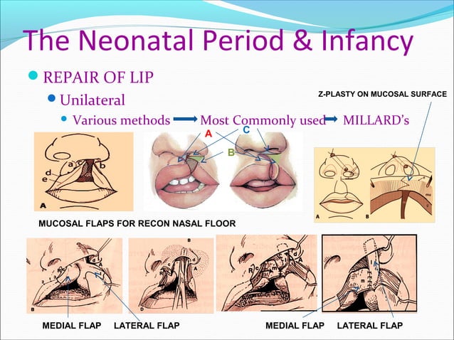 Clinical aspects of cleft lip and palate reconstruction 2 rec | PPT ...
