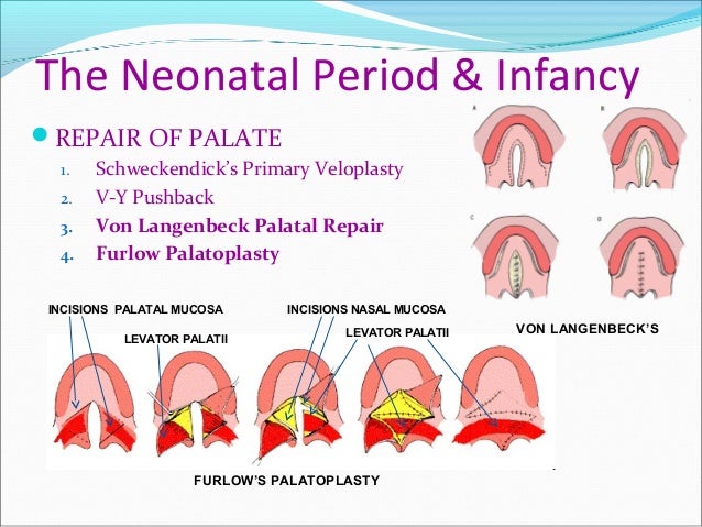 Clinical aspects of cleft lip and palate reconstruction 2 rec