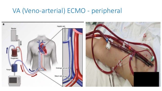 RVADs/LVADs and all things mechanical by Dr Jayshree Lavana