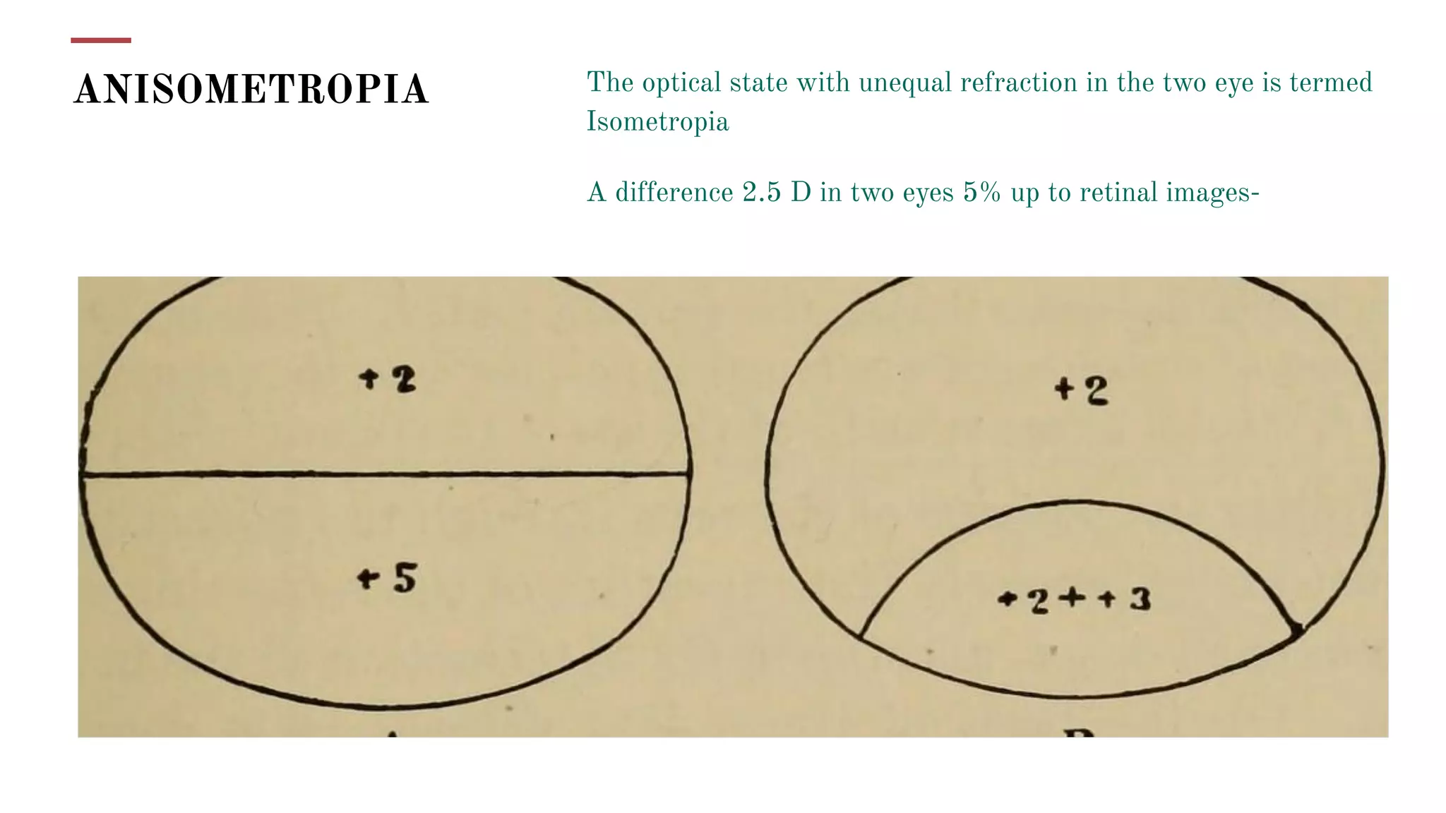 Refractive error | PDF