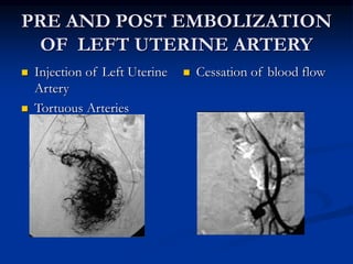 uterine artery embolization at dubois regional medical center | PPT