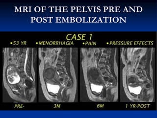 uterine artery embolization at dubois regional medical center | PPT