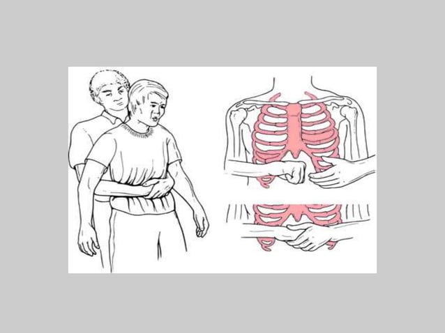 upper air way obstruction | PPTX