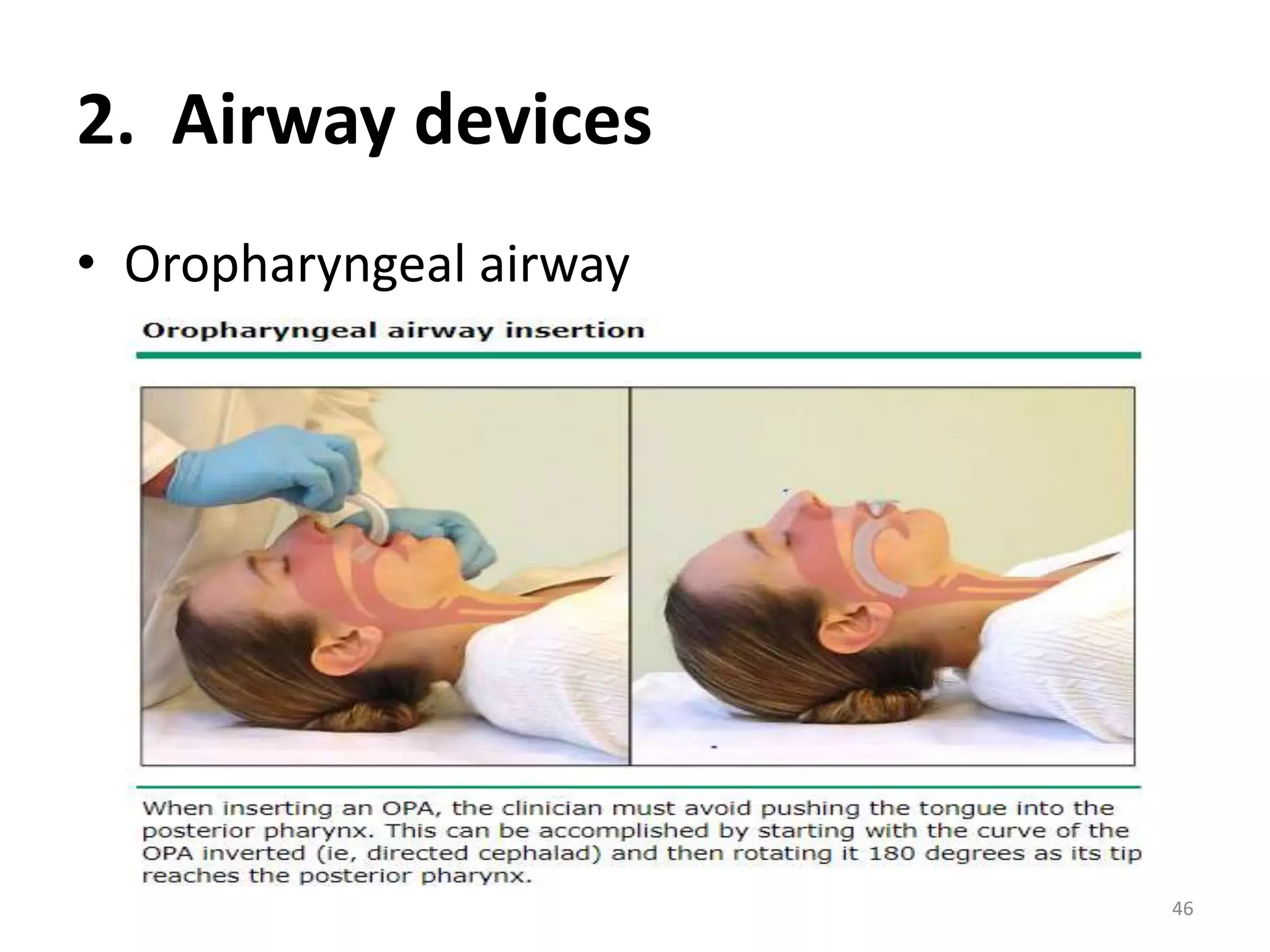 Upper airway obstruction.pptx