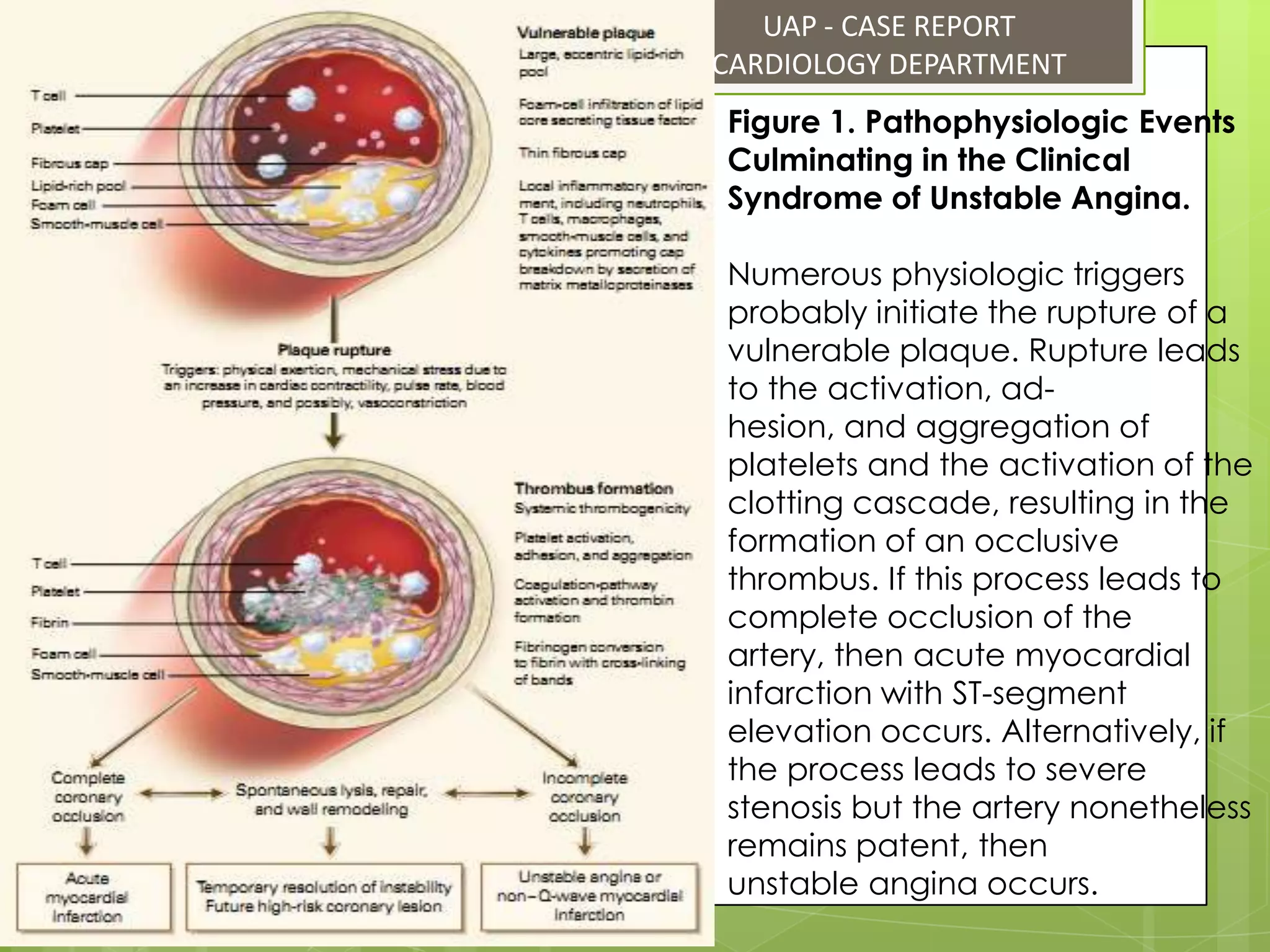 Unstable Angina Pectoris | PPTX