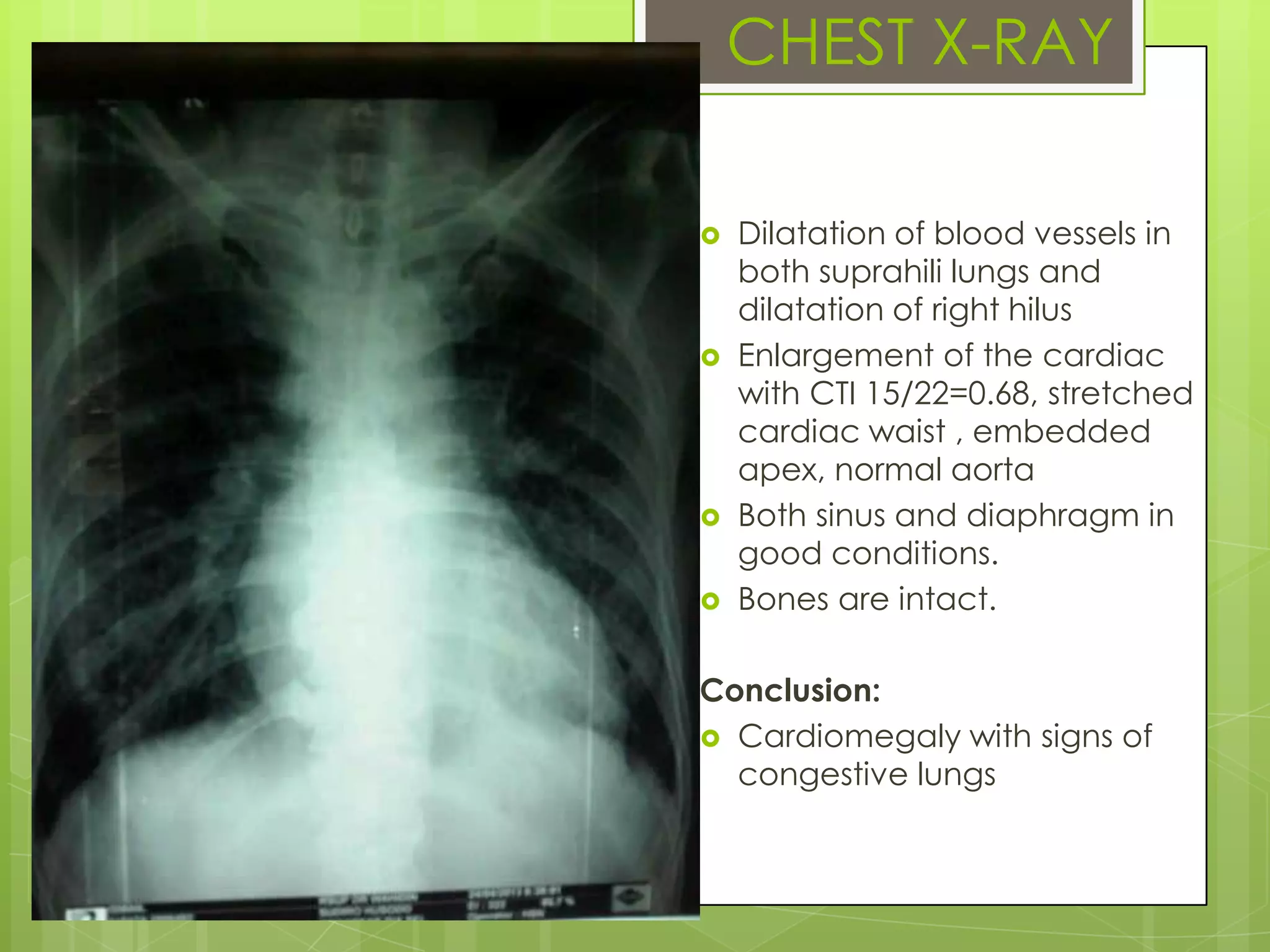 Unstable Angina Pectoris | PPTX
