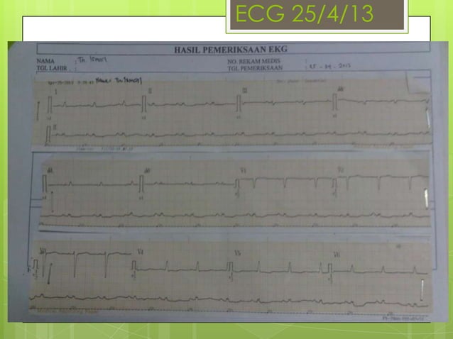 Unstable Angina Pectoris | PPTX | Heart and Cardiovascular Diseases ...