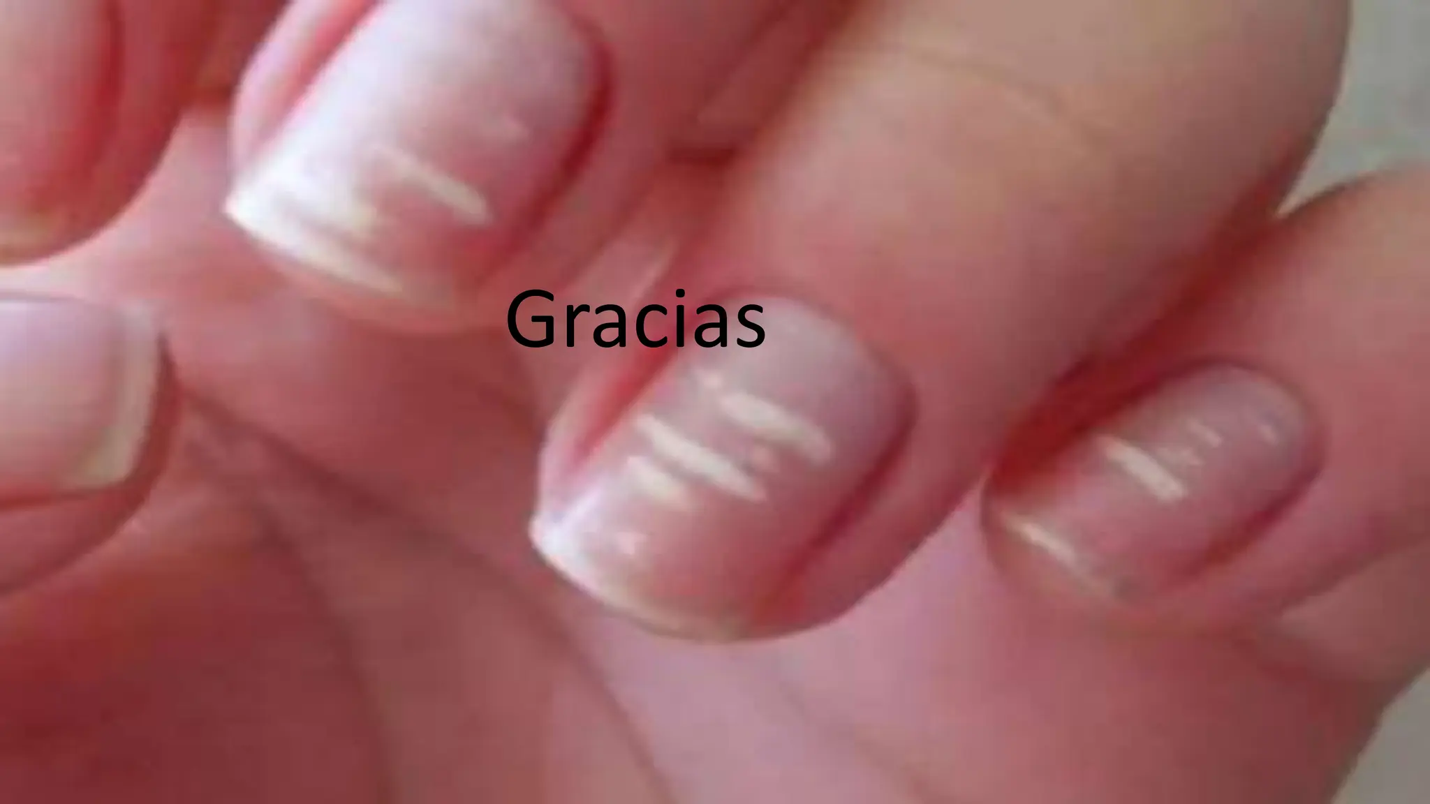 Uñas Estriadas Diagnostico y Tratamiento .pptx
