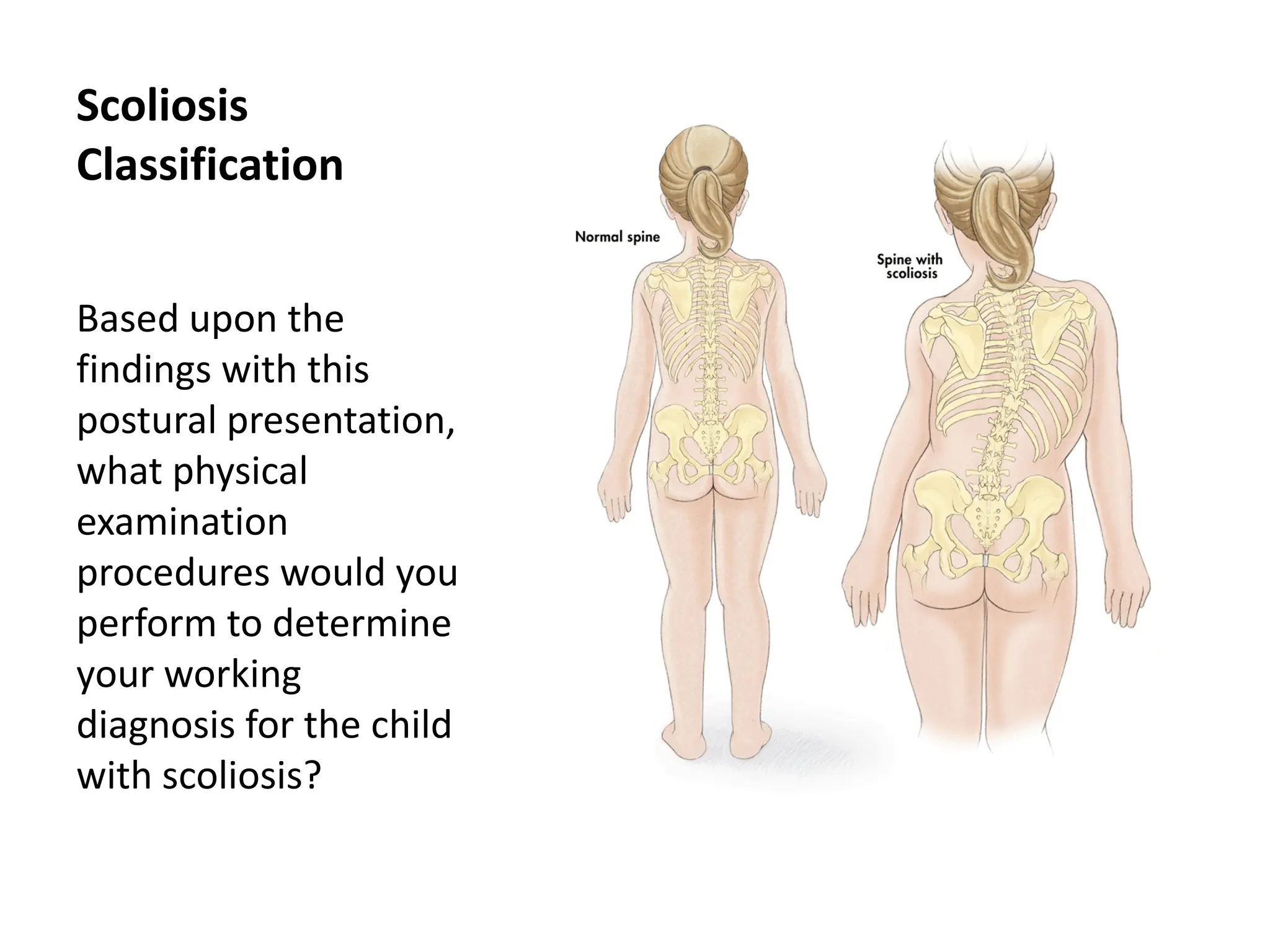 ub-hsped-scoliosis-differential-dx-functional-and-structural-scoliosis.pdf