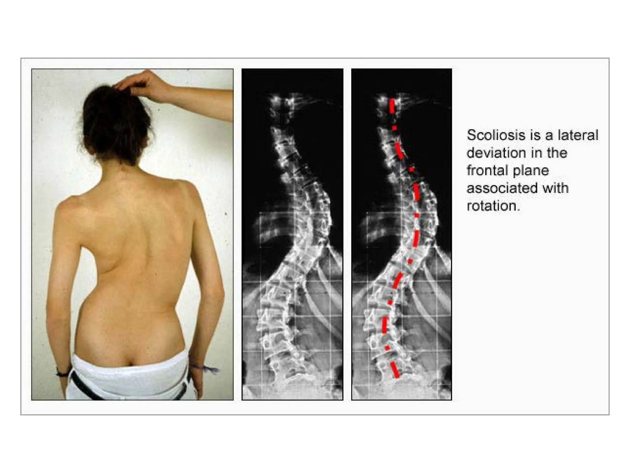 ub-hsped-scoliosis-differential-dx-functional-and-structural-scoliosis.pdf