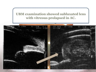 Ubm of blunt trauma in pediatric population | PPT