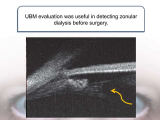 Ubm of blunt trauma in pediatric population | PPT