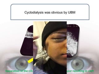 Ubm of blunt trauma in pediatric population | PPT