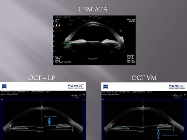 Ubm v oct poster escrs 2010 | PPT