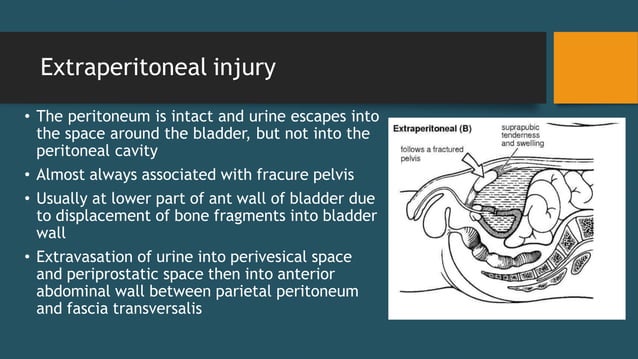 Urinary bladder trauma.pptx