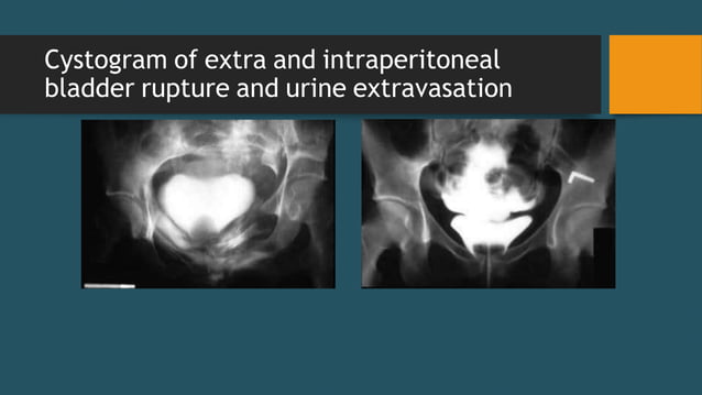 Urinary bladder trauma.pptx