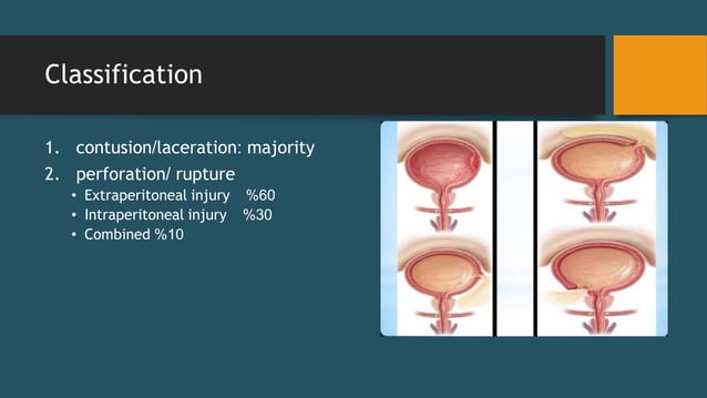 Urinary bladder trauma.pptx