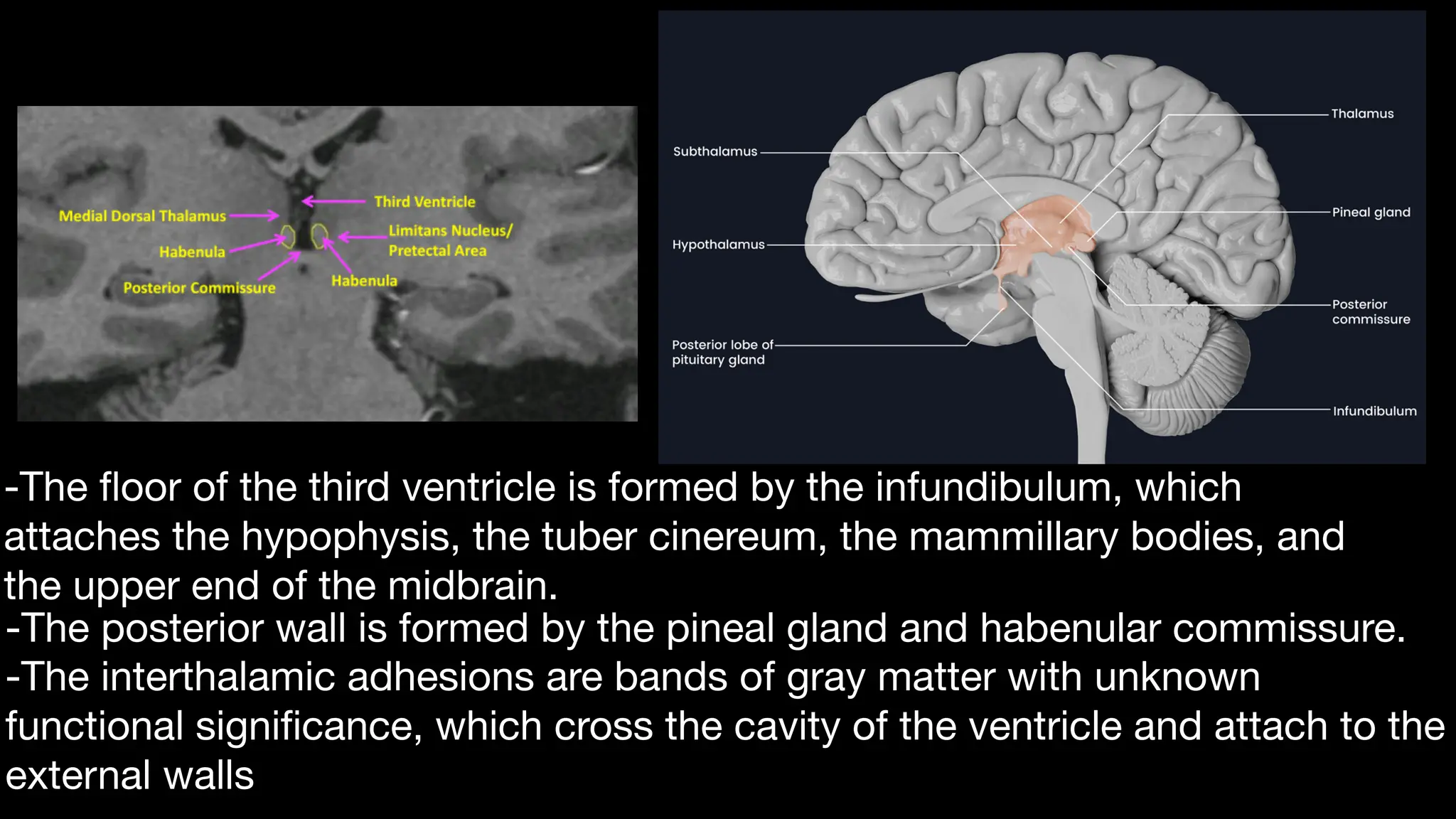 Ventricles_of_the_brain_The ventricles of the brain are a communicating ...