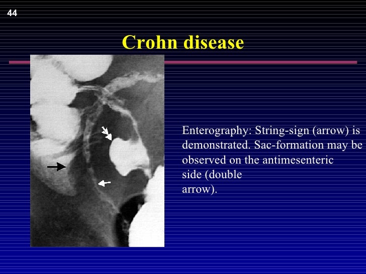 Enfermedad Inflamatoria de Intestino ¿Como Diagnosticarla? - www.grup…