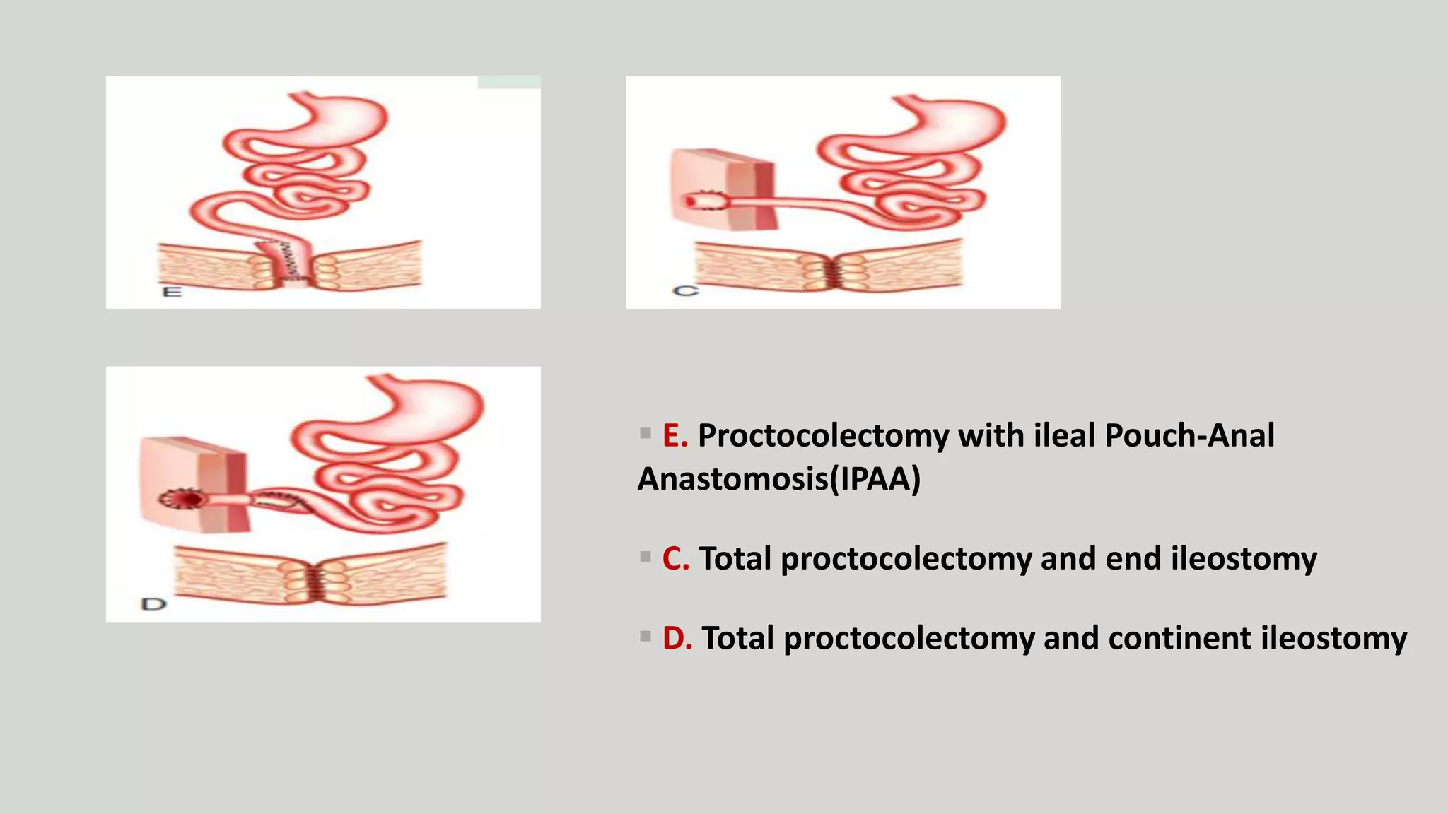 ULCERATIVE COLITIS MANAGEMENT | PPTX